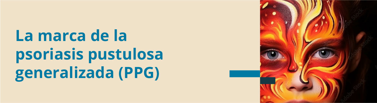 La marca de la psoriasis pustulosa generalizada | Avances en PPG