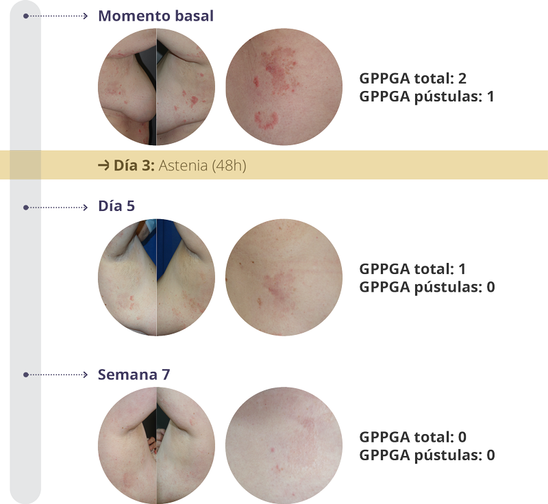 PPG anular tratada satisfactoriamente con espesolimab | Avances en PPG